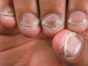 8 Ways Psoriatic Arthritis Affects the Nails - GoodRx