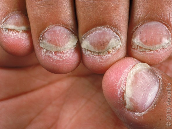 8 Ways Psoriatic Arthritis Affects the Nails - GoodRx