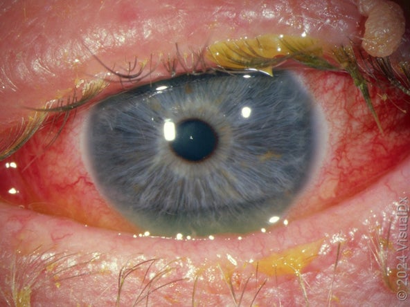 How Long Does Pink Eye Last? Pictures and Recovery Tips - GoodRx