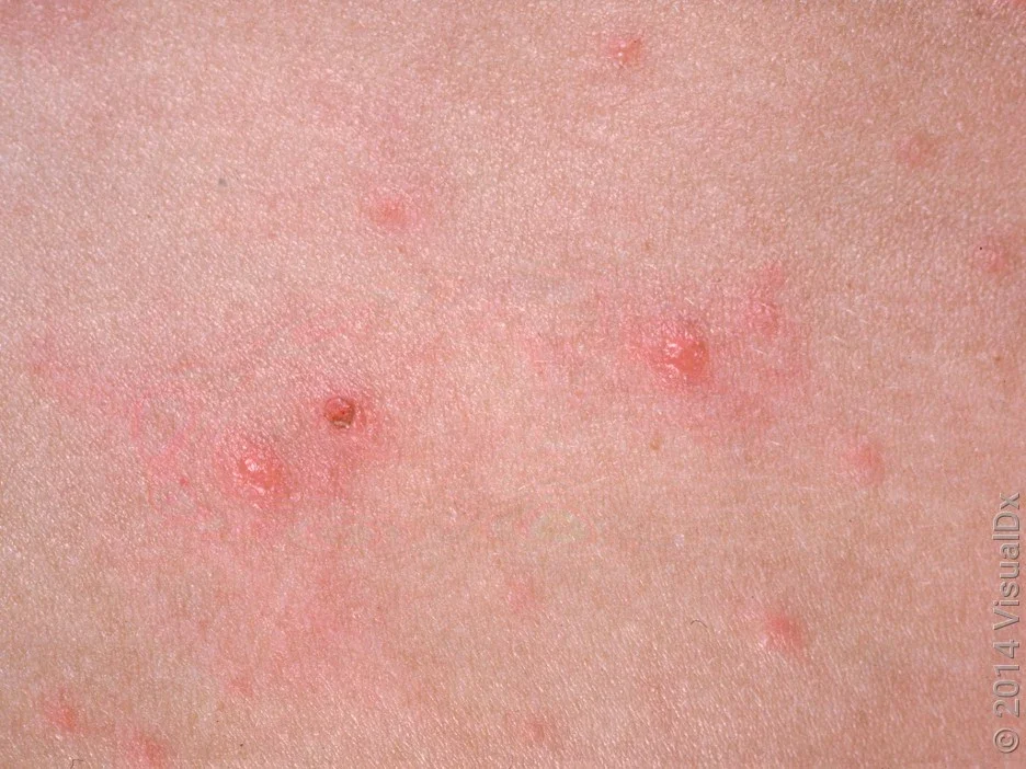 Chickenpox vs. Bug Bites: How to Tell the Difference - GoodRx