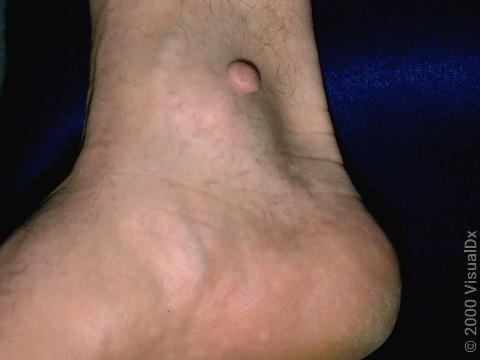 Dermatofibroma: Pictures, Causes, and Removal - GoodRx