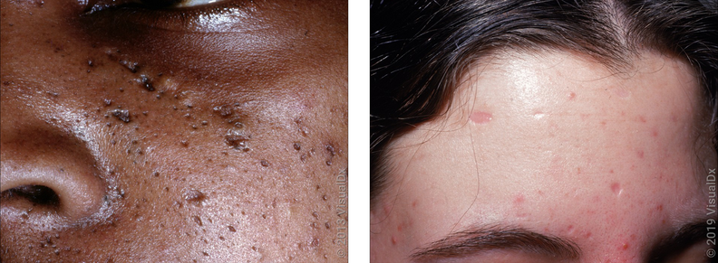 Best Treatments for Acne Scars (With Images) - GoodRx