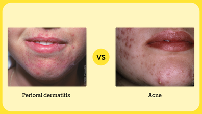 What Does Perioral Dermatitis Look Like? - GoodRx