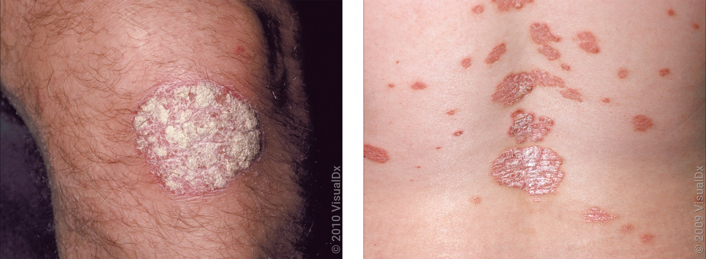 Psoriasis vs. Eczema: Images and Key Differences - GoodRx