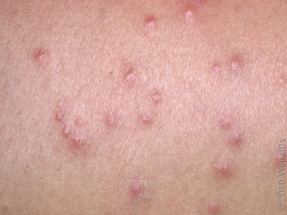 Pictures of Flea Bites on Humans, Plus Treatments - GoodRx