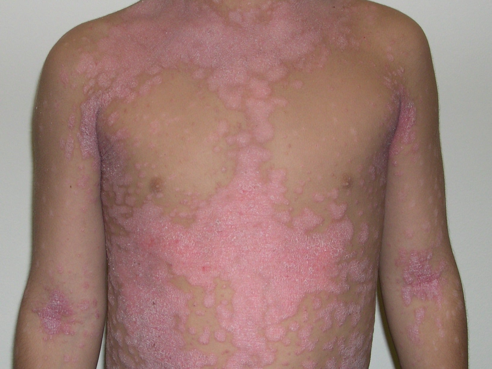 Psoriatic Arthritis Rash: Images, Symptoms, and Treatment - GoodRx Psoriatic Arthritis Rash: Images, Symptoms, and Treatment - GoodRx