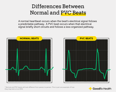 What It Means If You Have Premature Ventricular Contractions (PVCs) on ...