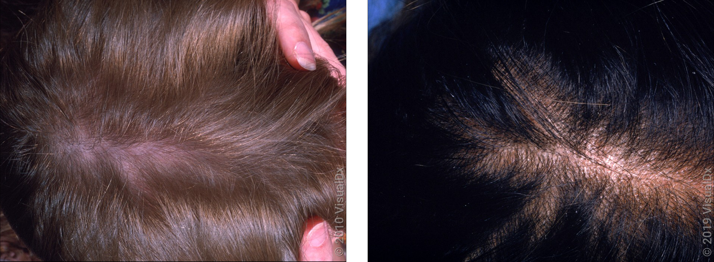 Telogen Effluvium: Causes, Images, and Treatments - GoodRx