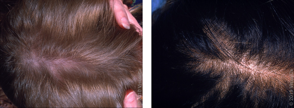 Telogen Effluvium: Causes, Images, and Treatments - GoodRx