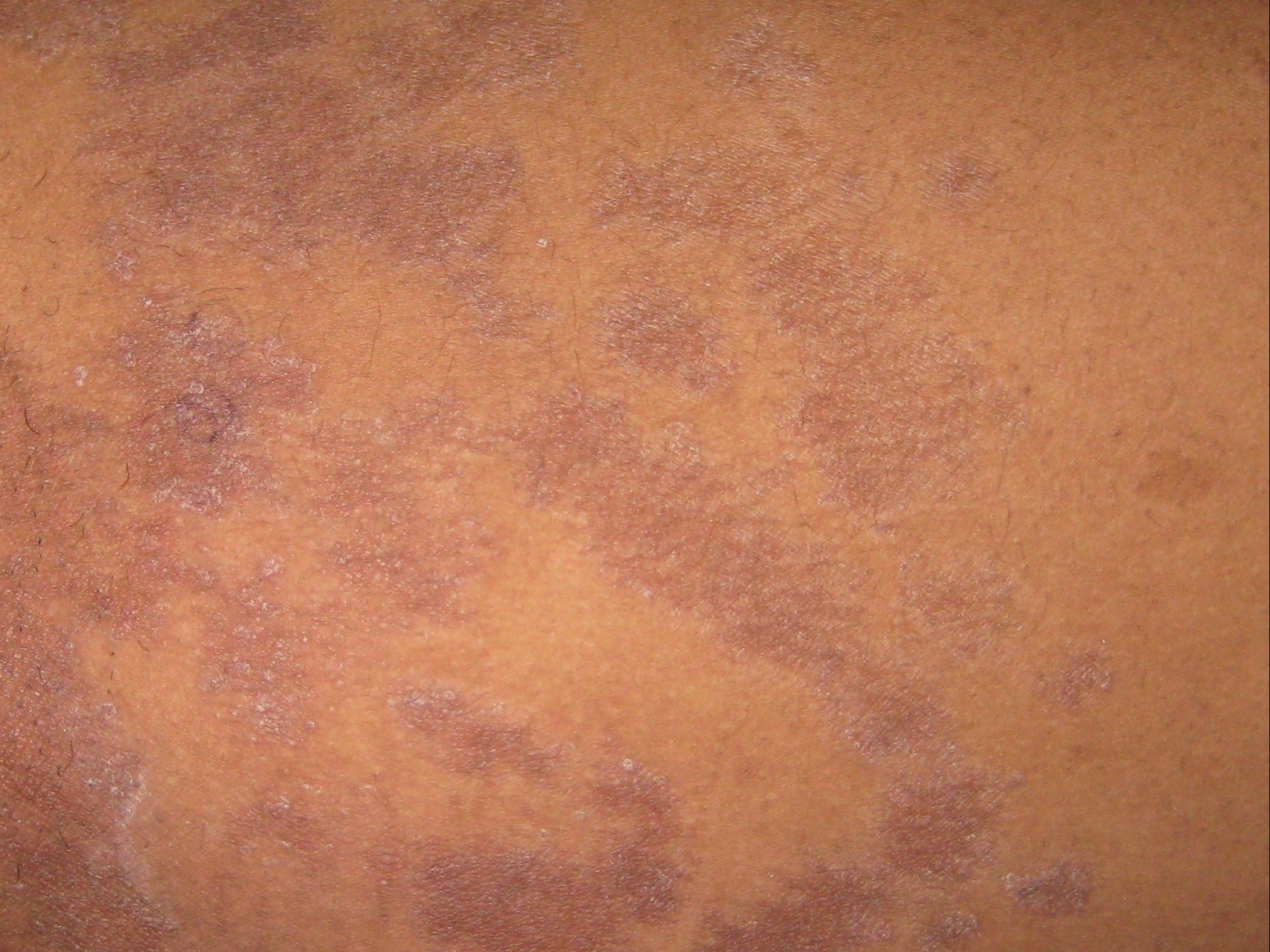 Psoriatic Arthritis Rash: Images, Symptoms, and Treatment - GoodRx