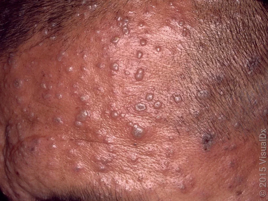 chicken pox forehead