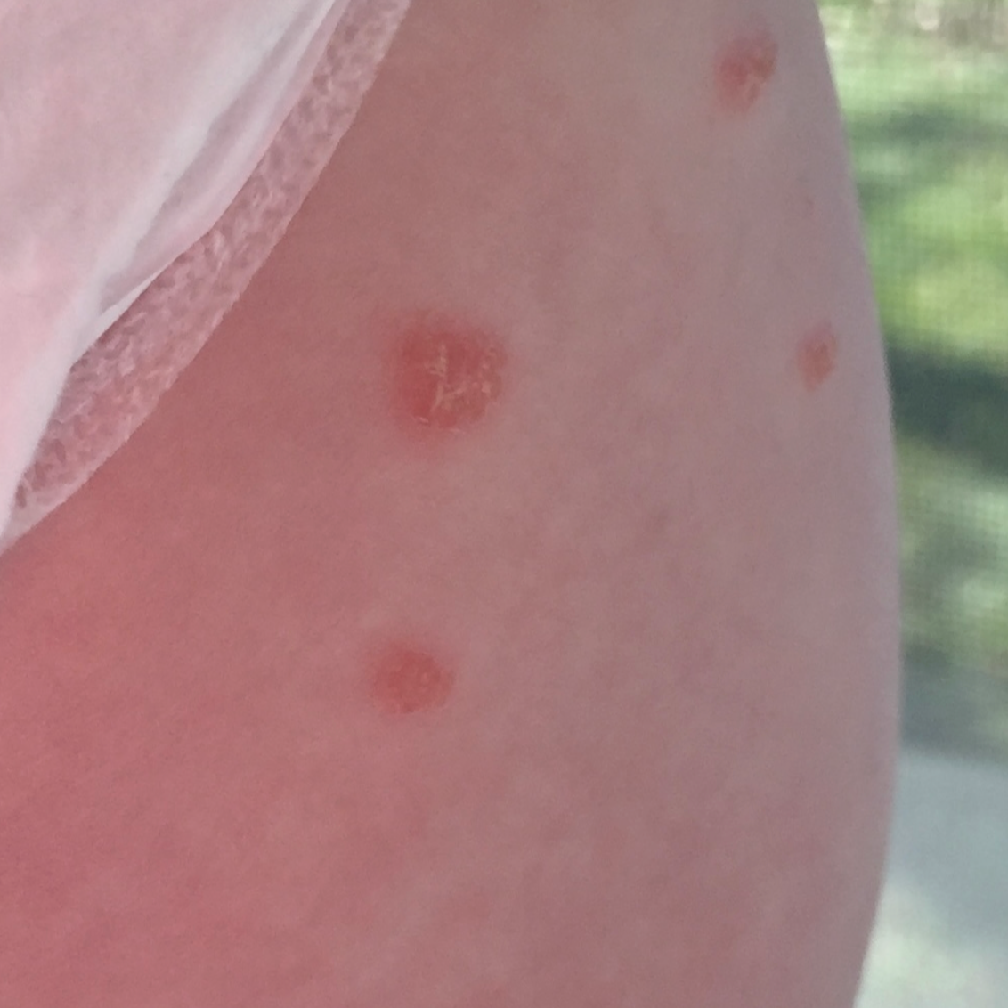 Psoriatic Arthritis Rash: Images, Symptoms, and Treatment - GoodRx Psoriatic Arthritis Rash: Images, Symptoms, and Treatment - GoodRx