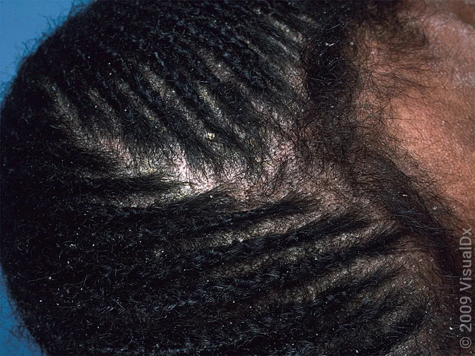 9 Dandruff Causes and How to Avoid Them (With Pictures) - GoodRx