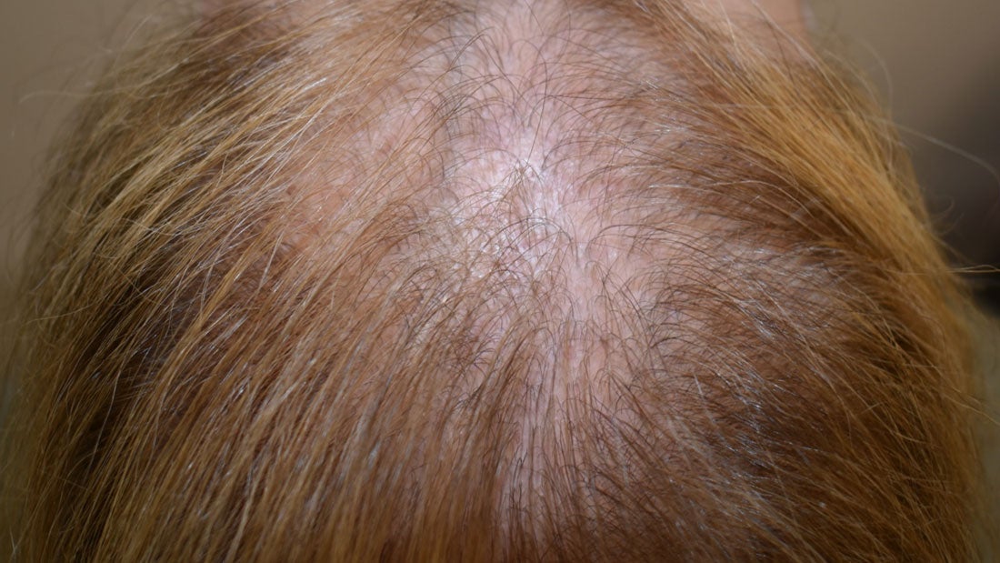 Female-Pattern Baldness: Causes, Treatments, and More - GoodRx