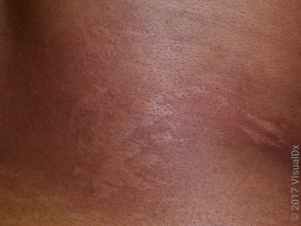 What Causes Hives? 7 Possible Triggers - GoodRx