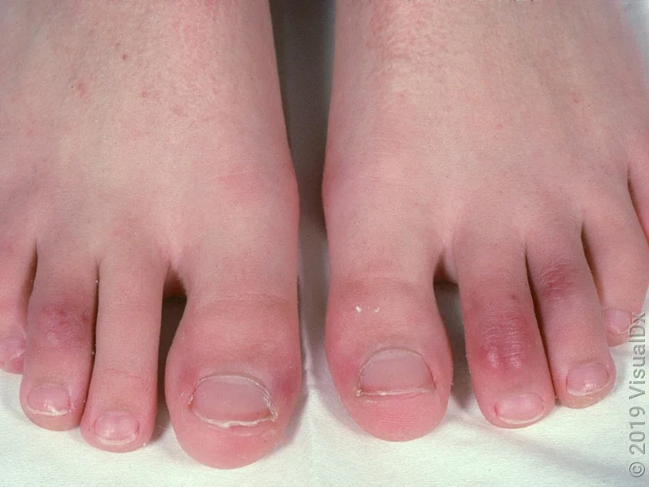 What Are Chilblains ? Causes, Symptoms, Treatment, and More - GoodRx