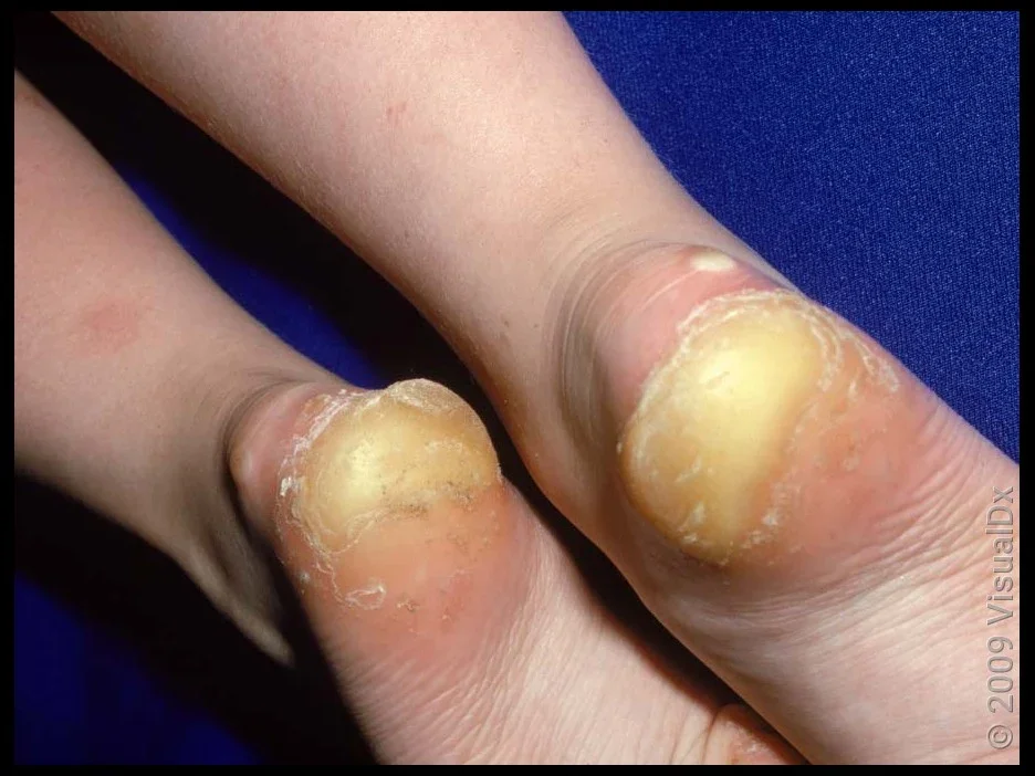 callus on second toe knuckle