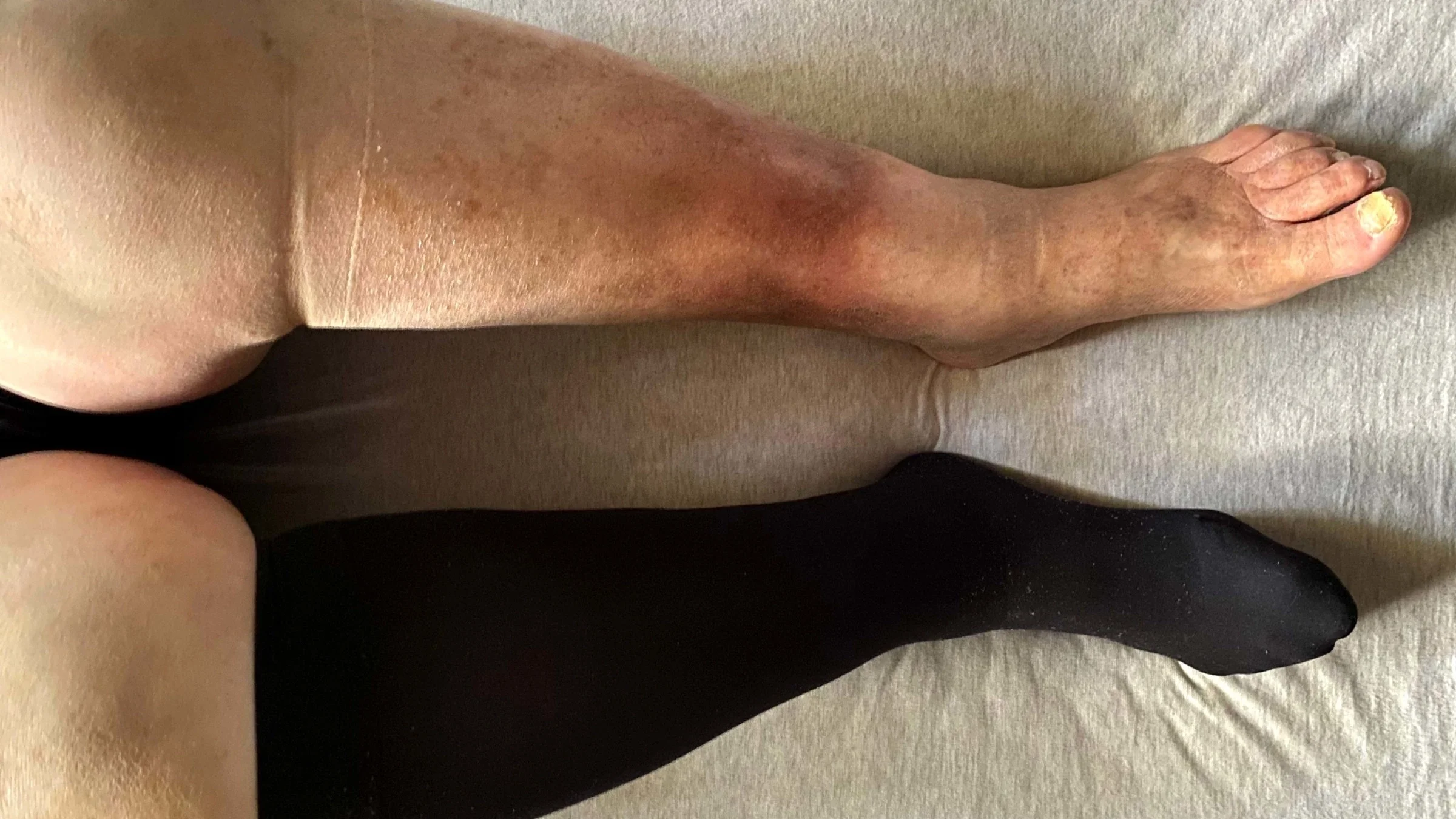 Cellulitis: Symptoms, Causes, and Treatment (With Images) - GoodRx