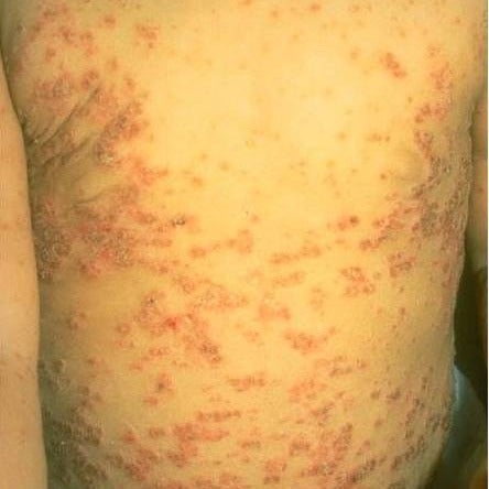 Psoriatic Arthritis Rash: Images, Symptoms, and Treatment - GoodRx