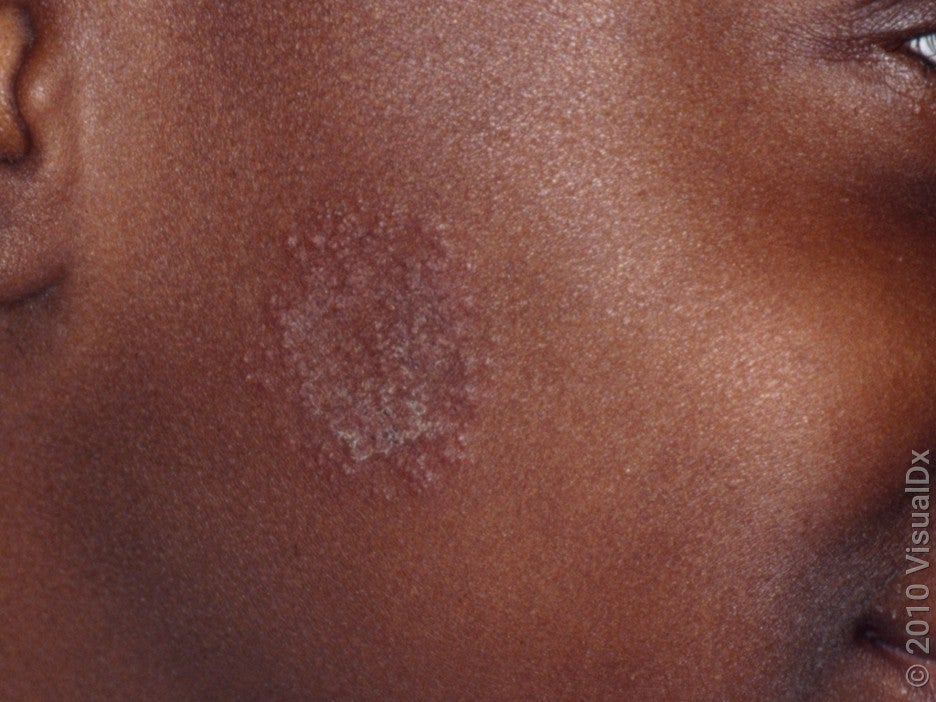 Ringworm: Symptoms, Pictures, Causes, Treatment, & More - GoodRx