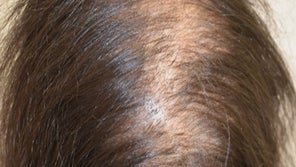 Female-Pattern Baldness: Causes, Treatments, and More - GoodRx