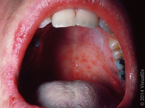 What Is Measles? Causes, Symptoms, Pictures, and Treatments - GoodRx