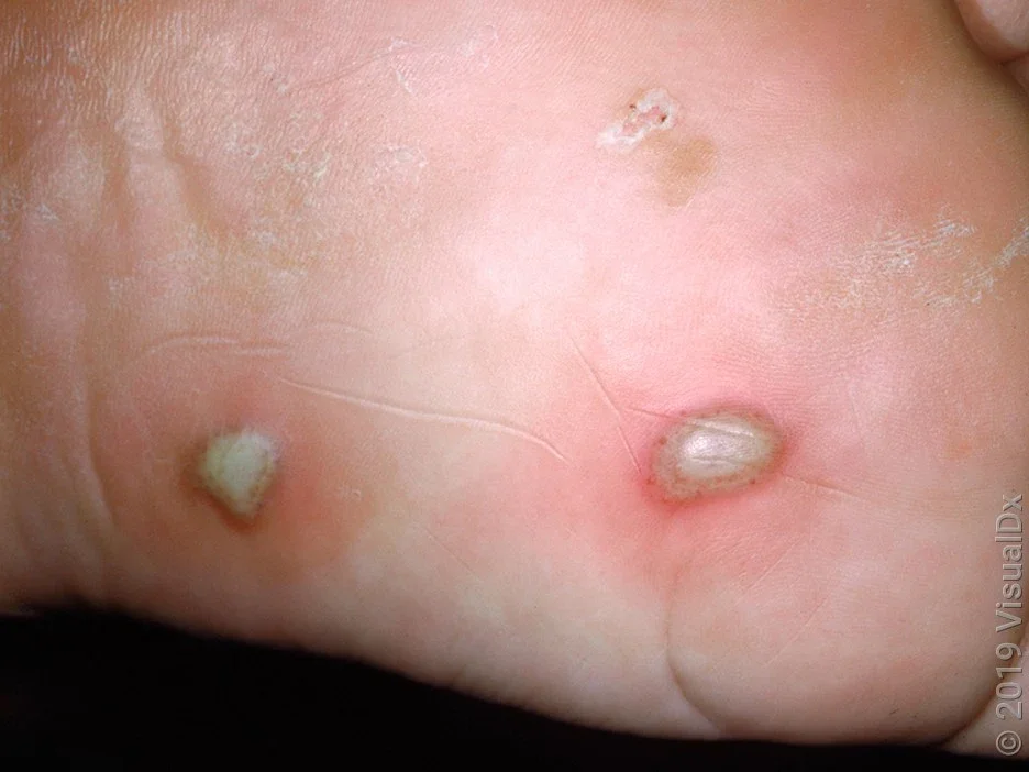Athlete’s Foot (Tinea Pedis): Causes, Images, and Treatment - GoodRx