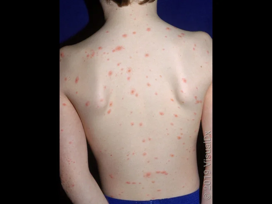 Can You Get Chickenpox Twice? Yes, But It’s Rare - GoodRx
