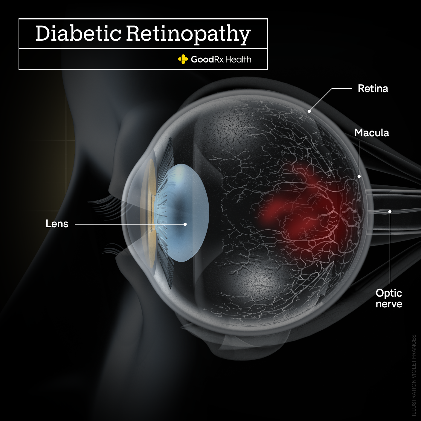 Diabetic Eye Problems: Symptoms and Treatment - GoodRx