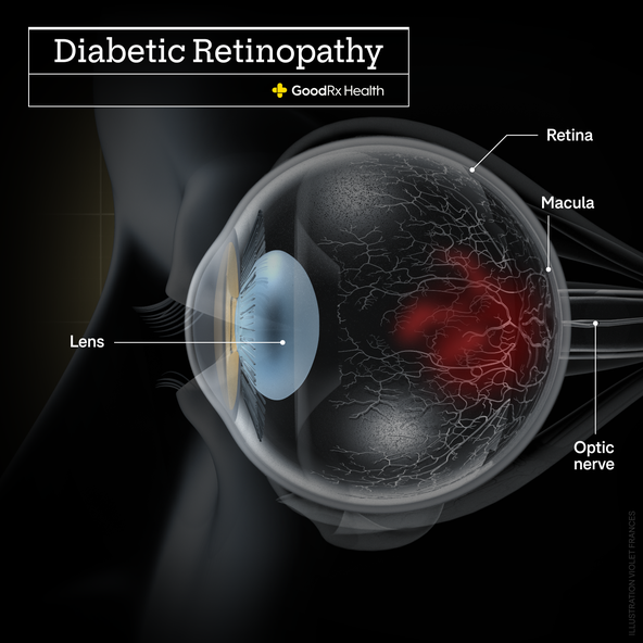Diabetic Eye Problems: Symptoms and Treatment - GoodRx