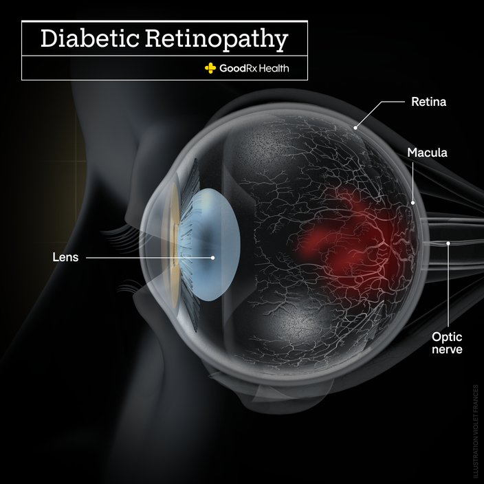 Diabetic Eye Problems: Symptoms and Treatment - GoodRx