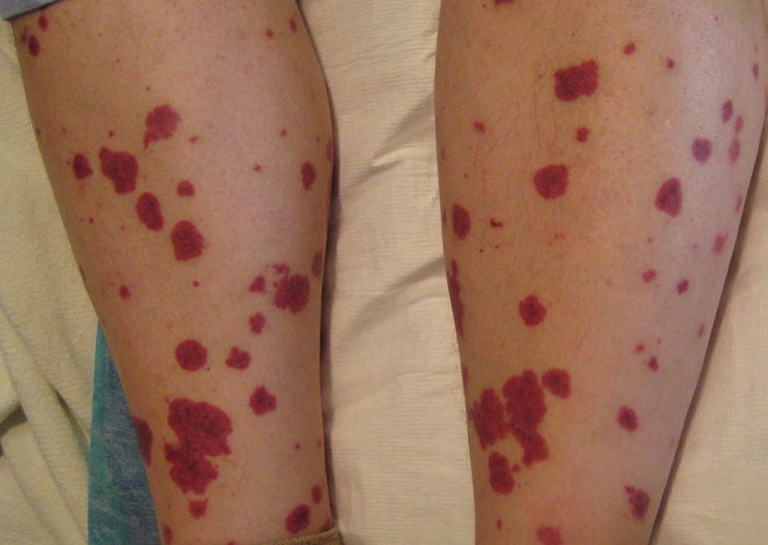 Lupus Rash: What It Is and How to Treat It - GoodRx
