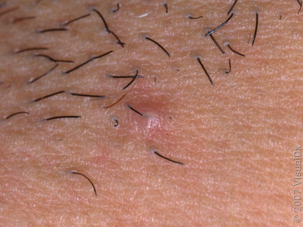 Ingrown Hairs: 6 Ways to Prevent Them - GoodRx