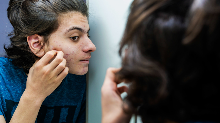 How to Get Rid of Pimples Fast: 7 Tips to Know - GoodRx