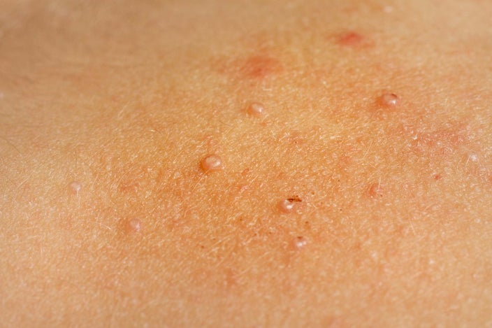 Molluscum Contagiosum Treatment Options - GoodRx