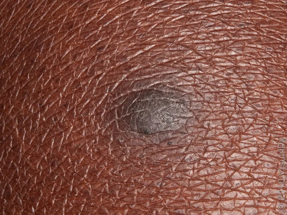 Dermatofibroma: Pictures, Causes, and Removal - GoodRx