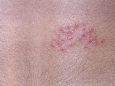 What Are Shingles? Symptoms and Treatment - GoodRx
