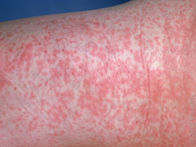 Rubella vs. Rubeola (Measles): Differences, Photos, and More - GoodRx