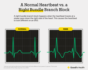RBBB and EKGs: Diagnosing Right Bundle Branch Blocks - GoodRx