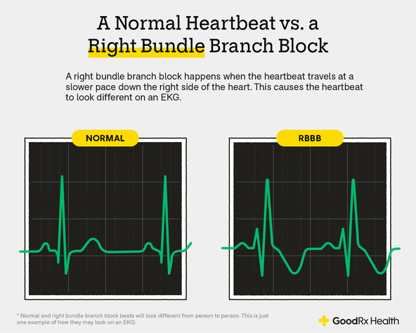 RBBB and EKGs: Diagnosing Right Bundle Branch Blocks - GoodRx RBBB and EKGs: Diagnosing Right Bundle Branch Blocks - GoodRx