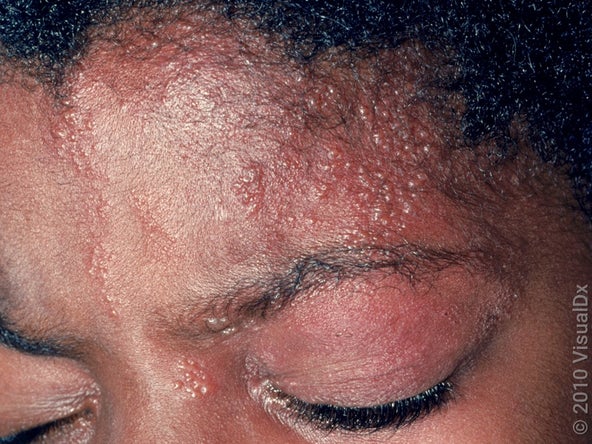 The Connection Between COVID-19 and Shingles (With Images) - GoodRx