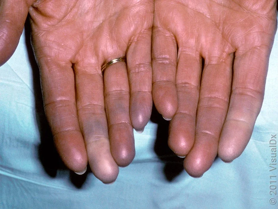 Raynaud’s Syndrome: Symptoms, Causes, and Pictures - GoodRx