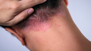 What Is Psoriasis? Symptoms, Causes, & Treatments (With Images) - GoodRx