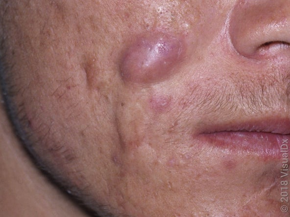 Acne Treatment: A Complete Guide (With Images) - GoodRx