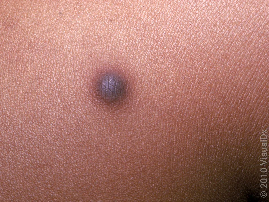 Dermatofibroma: Pictures, Causes, and Removal - GoodRx