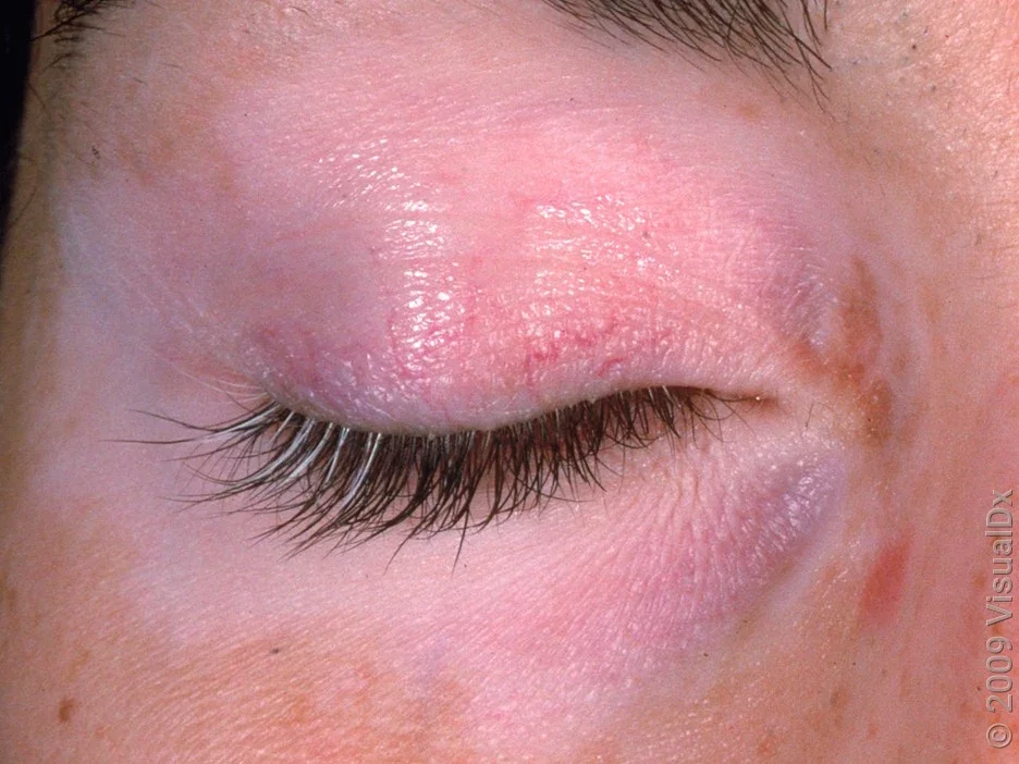 Diabetes Rash: Photos, Causes, and Care - GoodRx