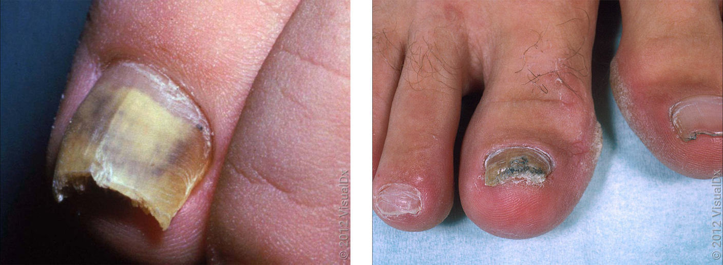 Toenail Fungus Treatment: What Works? - GoodRx