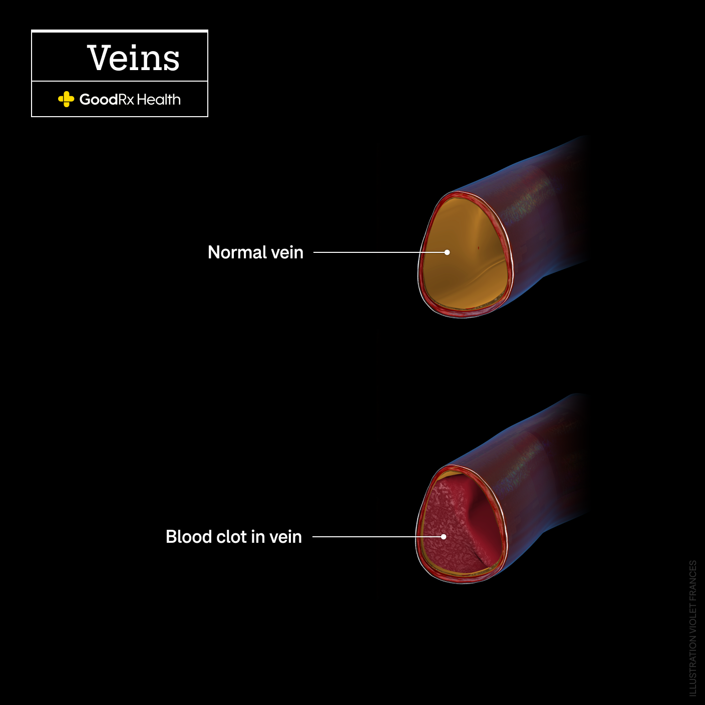 What Does a Blood Clot Feel Like? - GoodRx