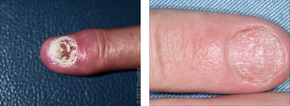 Psoriasis Nails vs. Fungus: Pictures and Differences to Look For - GoodRx