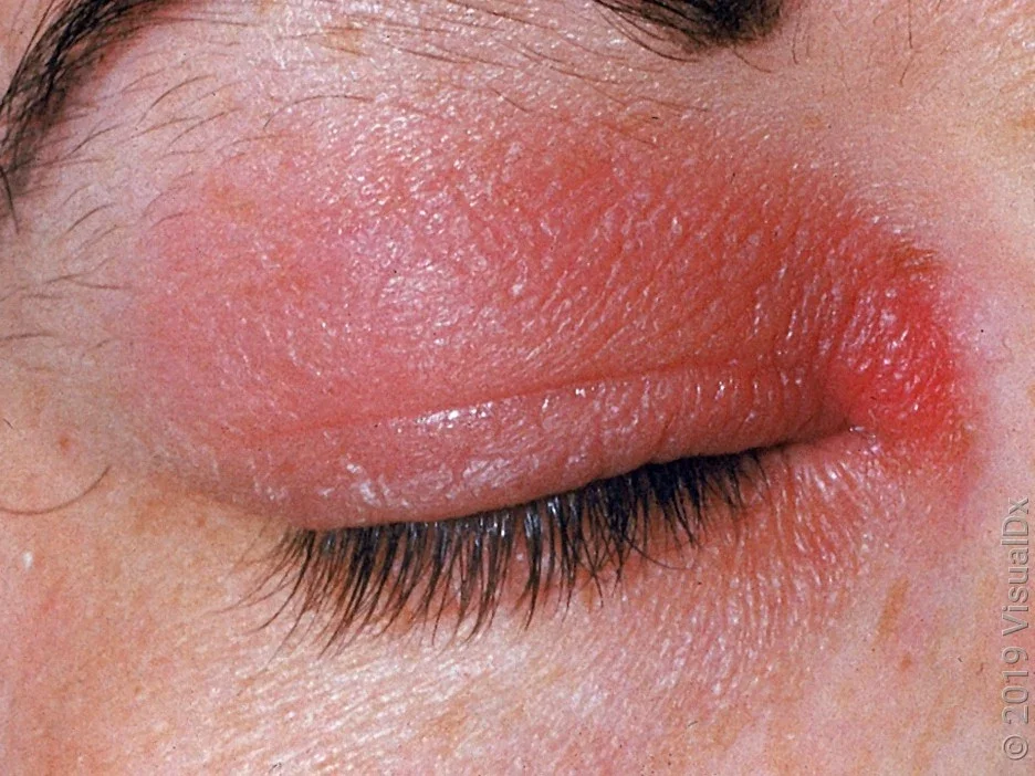 Scabies vs. Eczema: Symptoms and Photos - GoodRx
